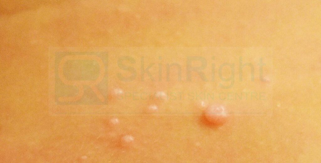 Molluscum contagiosum - 香港皮膚科醫生 - SkinRight Skin Surgery and Laser ...