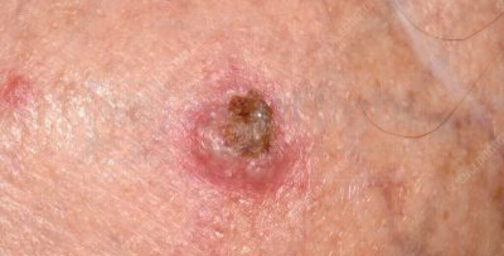 Skin Cancers - 香港皮膚科醫生 - SkinRight Skin Surgery and Laser Centre ...
