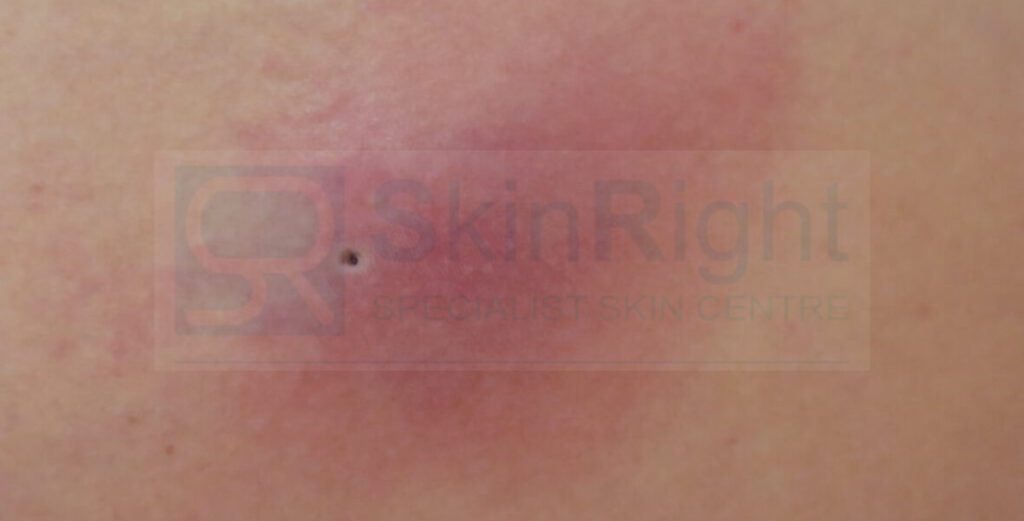 Epidermoid Cyst - SkinRight Skin Surgery and Laser Centre 健衛皮膚手術及激光中心