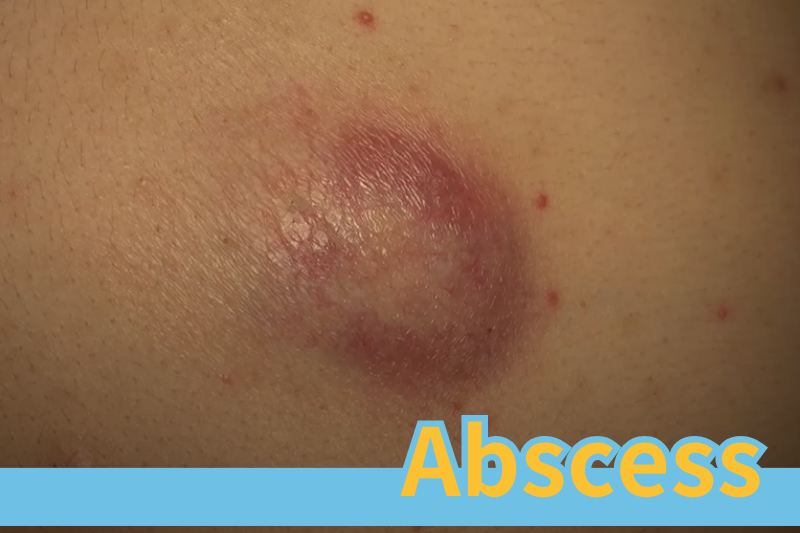 Symptoms, Diagnosis, and Treatment of Abscesses - SkinRight Skin ...