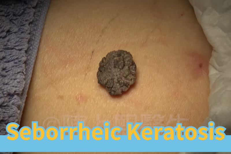 Seborrheic Keratosis: A Comprehensive Guide from Diagnosis to Treatment ...